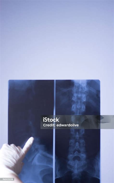 의료 병원 엑스레이 로우 허리 통증 척추와 엉덩이 학 스캔 X 레이에 대한 스톡 사진 및 기타 이미지 X 레이 X 레이
