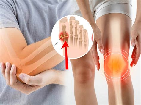 शरीरातील युरिक अ‍ॅसिड वाढलं तर होतो हा गंभीर आजार सुरु करा या