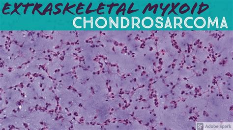 Chondrosarcoma Histology Drawing