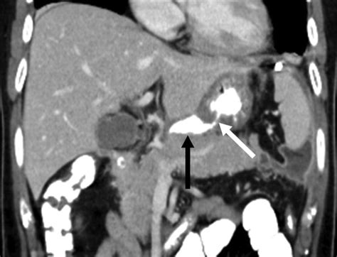 Greater And Lesser Omenta Normal Anatomy And Pathologic Processes
