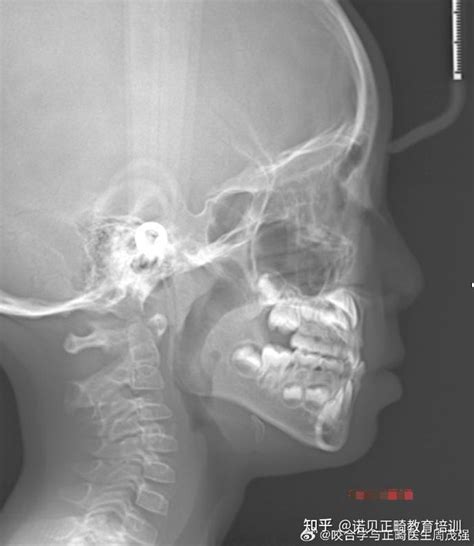 Tpa 纠正儿童反颌的利器 知乎
