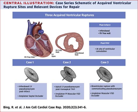 Percutaneous Repair Of Ventricular Ruptures Jacc Case Reports