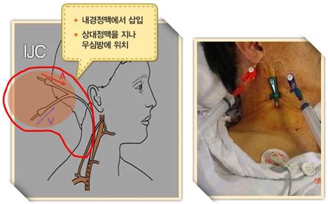 펌카테터와 내경정맥카테터 Perm Cath And Ijc 네이버 블로그