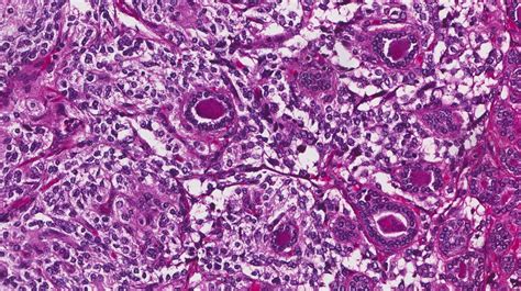 Medullary Thyroid Carcinoma Atlas Of Pathology