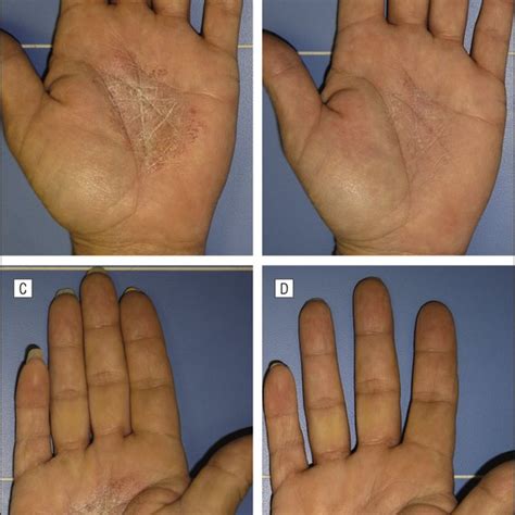 Erythema Scaling Induration Fissuring Scale Download Table