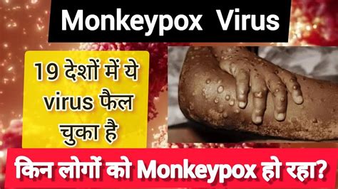 Monkeypox Explained Clearly: Symptoms, Disease, Treatment and Prevention. W Academy - YouTube