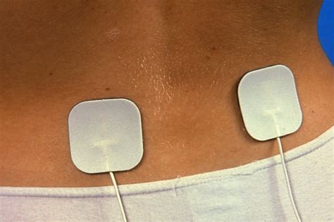TENS Transcutaneous Electrical Nerve Stimulation NHS