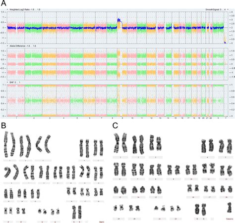 The Cma And Karyotyping Results Of No 50 Patients A Cma Result B Download Scientific