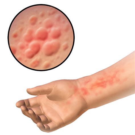 Urticaria The Bmas Blog