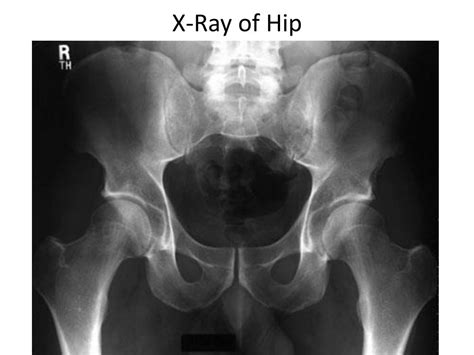 Ppt Lower Limb Osteology Powerpoint Presentation Free Download Id