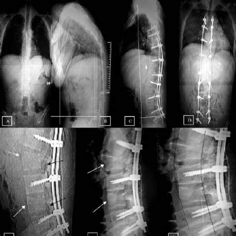 PDF Partial Pedicle Subtraction Osteotomy PPSO A Modification For