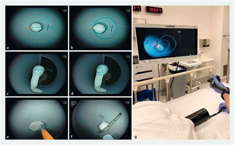 Polyp Size Estimation Using The Visual Scale Endoscope With Linear Download Scientific Diagram