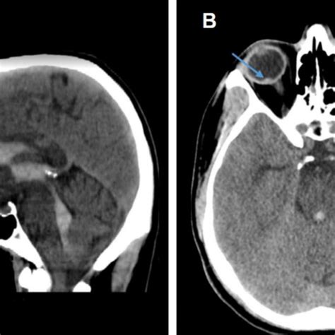 A Brain Ct Scan Shows Intraventricular Haemorrhage In Both Lateral