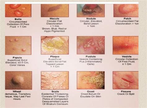 Skin Lesions Practical 3 And 4 Flashcards Quizlet