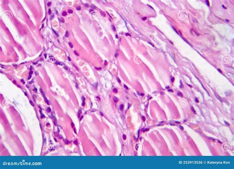 Fibrous Thyroiditis Light Micrograph Stock Image 253913155