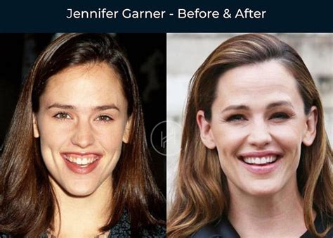 Real Dentures Before And After Comparison Dentist For Life