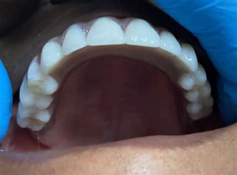 6 Implants In The Maxillary Upper Arch With A Fixed Or Screw Retained Prosthesis All On 6 Case
