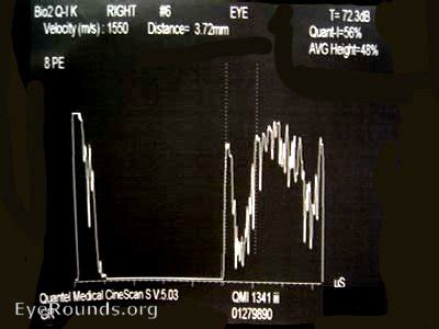 Atlas Entry Choroidal Melanoma Ultrasound