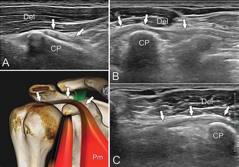 Coracohumeral Ligament Mri