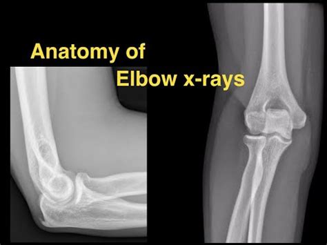 Elbow Joint X Ray Arthritic Elbow X Ray Stock Image M1100677