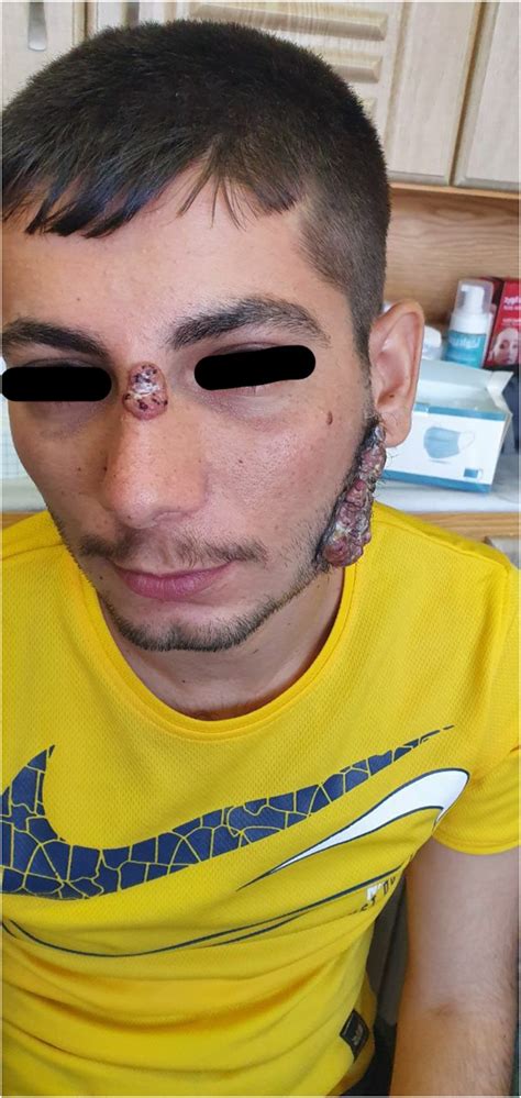 23 Year Old Male With Multiple Giant Facial Pyogenic Granulomas Being