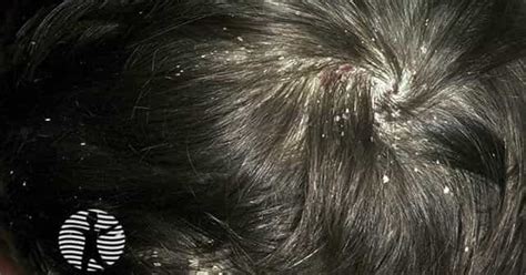Scalp Psoriasis Image