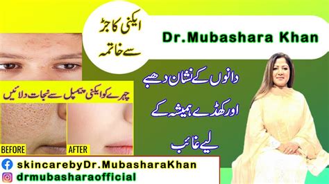 Chehre Ke Dano Ka Fori Ilaj How To Get Rid Of Acne Pimples