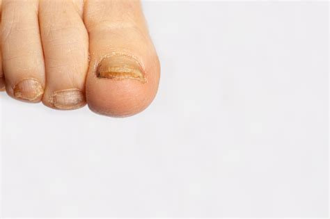 큰 발가락에 손톱의 곰팡이 피부과 오니초 마이코시스 곰팡이 감염 매크로 사진 피부과 손톱 진균증의 치료 55 59세에 대한 스톡