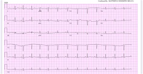 “irregular Ecg” R Readmyecg