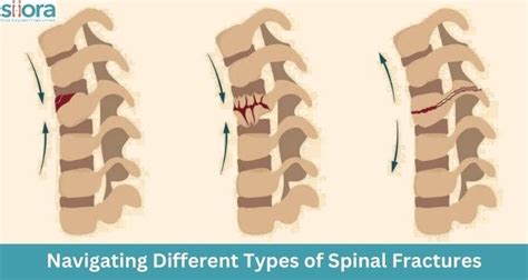 Navigating Different Types Of Spinal Fractures Siora Surgicals Medium