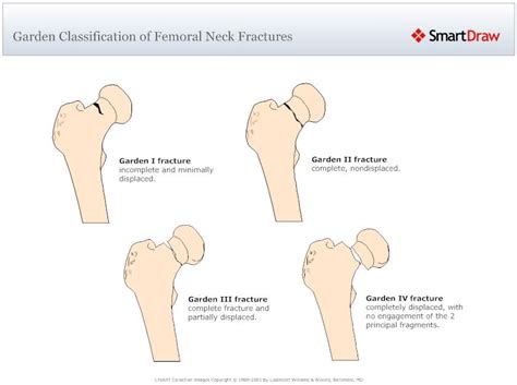 Different Types Of Femoral Neck Fractures At Kevin Davidson Blog