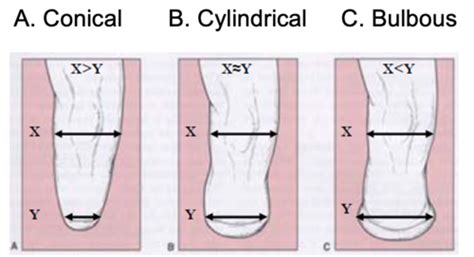 Amputation Flashcards Quizlet