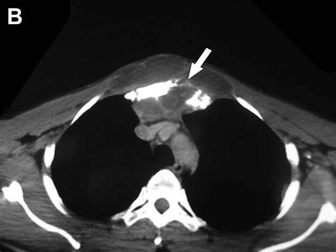 Computed Tomography Ct Scan Of The Chest Showing A Soft Tissue Mass