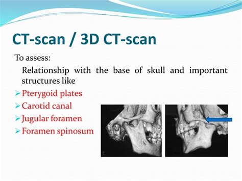 Temporomandibular Joint Ankylosis Pptx