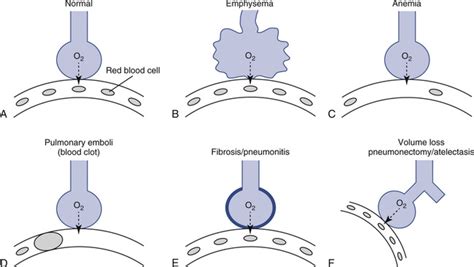 Diffusing Capacity Tests Clinical Gateclinical Gate