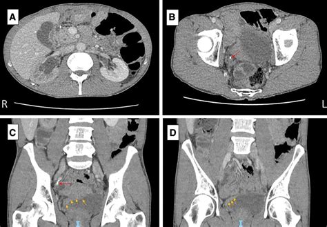 Case Report Discovery Of Bladder Metastasis From Primary Gastric Cancer During Management Of