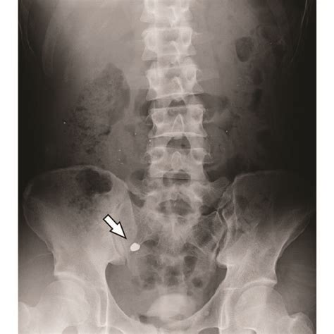 Abdominal X Ray Examination Radiopaque Object Consistent With A