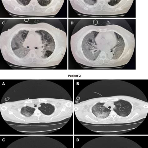 Chest Computed Tomography Scans Pretreatment B Below Showing