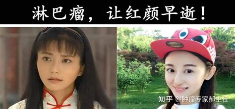 为什么年轻人容易得淋巴瘤？ 知乎