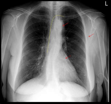 Picc Line Xray