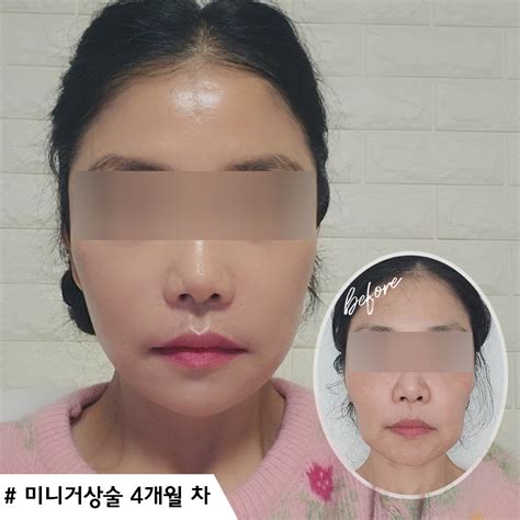 안면거상 리프팅은 빌리프성형외과 💕빌리프 동안美人 리얼셀카💕 수술항목 미니거상술지방정리 집도의 최진미 원장 ☑️