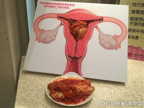 少子不孕元兇是你？女性不孕五成皆因子宮內膜異位症 Ettoday健康雲 Ettoday新聞雲