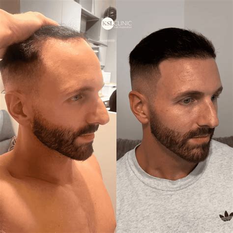 Hair Plugs Vs Hair Transplants Whats The Difference