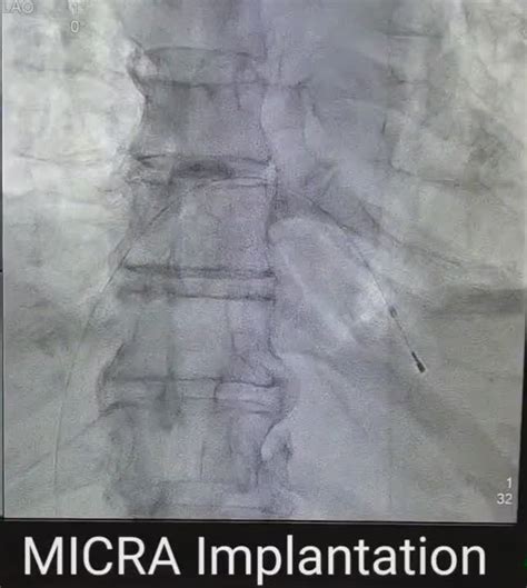 Shaik Masood Mohiddin On Linkedin Aster Dr Dr Medtronic