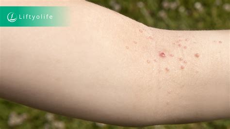 Contagious Skin Diseases Symptoms Treatment