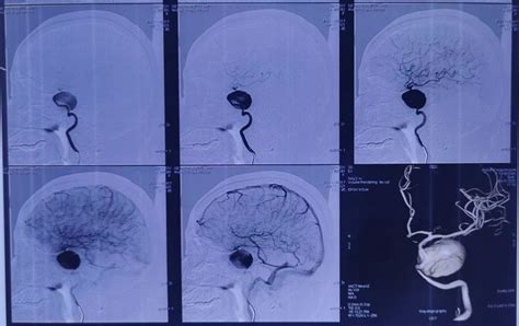 王胜 Sheng Wang On Linkedin The High Flow Bypass Of Intracranial Artery