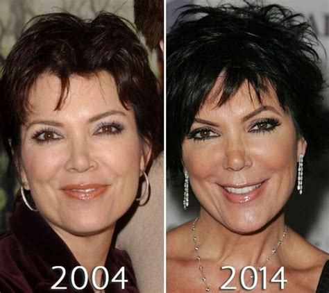 Kris Kardashian Plastic Surgery Before And After