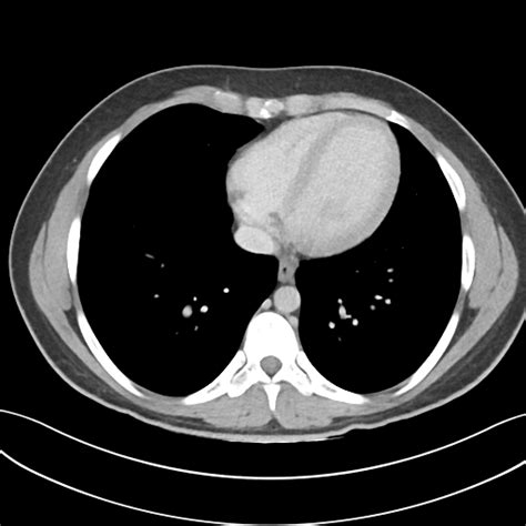 Acute Appendicitis With Appendicoliths Radiopaedia 50186 55532 Axial