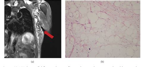 Figure 1 From Treatment For Intramuscular Lipoma Frequently Confused