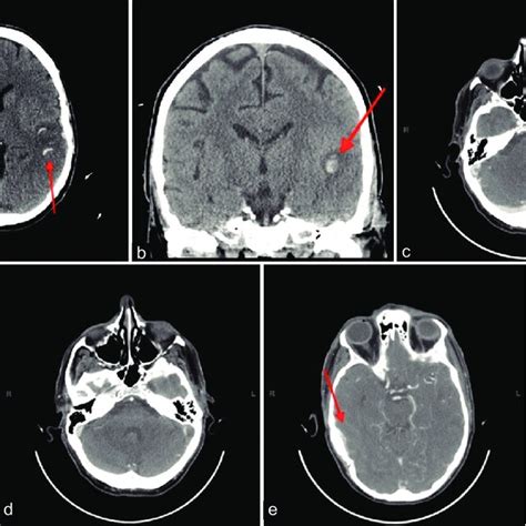 A Axial Non Enhanced Computed Tomography Ct Demonstrating Areas Of